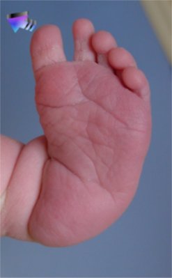 La classification Diméglio - soigner un pied bot