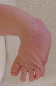 La classification Diméglio - soigner un pied bot